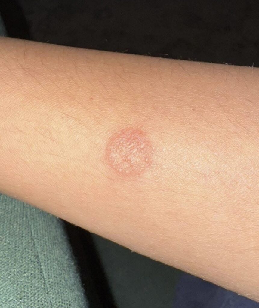 **5 enkla huskurer för att förebygga ringorm och hålla huden frisk ...